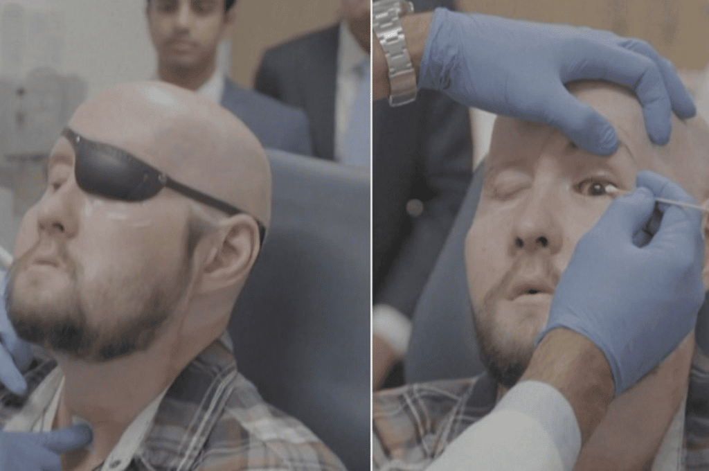 Realizaron con éxito el primer trasplante de ojo completo del mundo – Notife